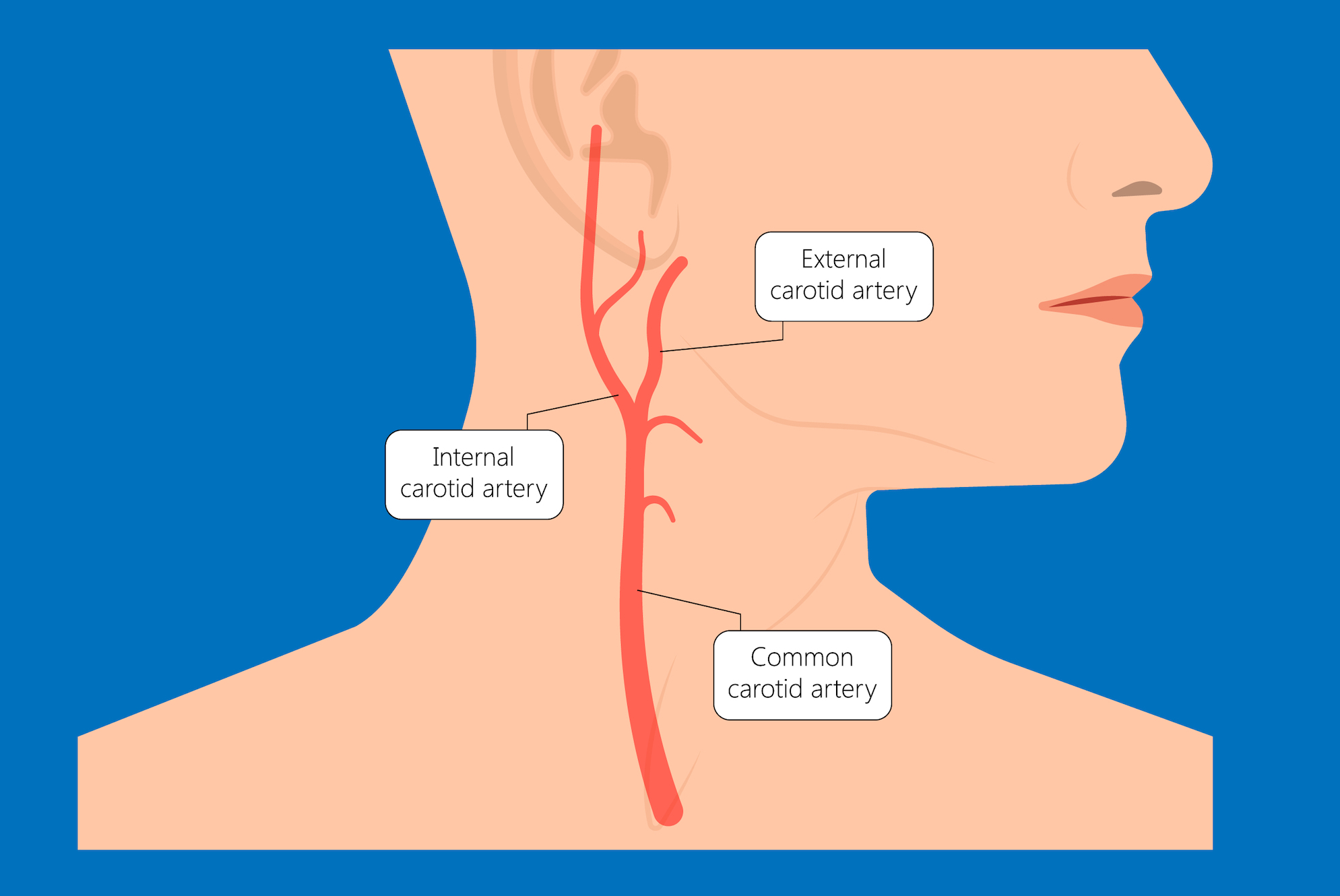 Carotid artery stenting in Coimbatore