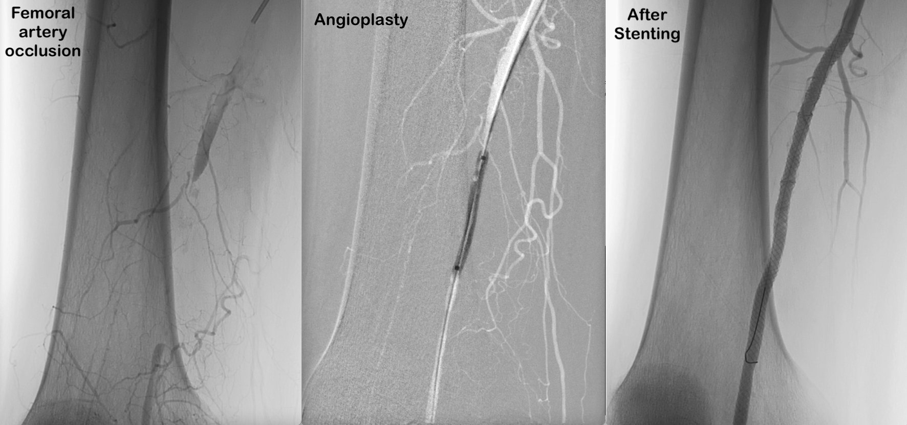 Angioplasty for Peripheral Vascular Disease in Coimbatore