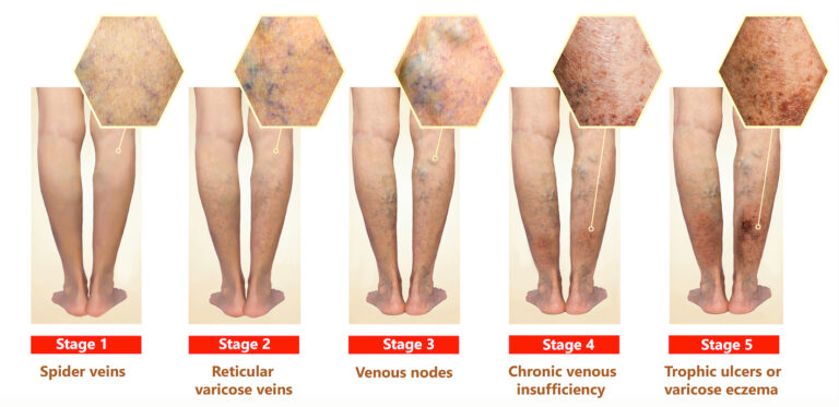 Laser treatment for Varicose veins in Coimbatore